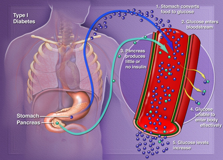 Type 1 Diabetes | UCSF Department of Surgery